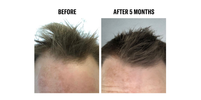 Hair Loss Treatments South Africa Andbam