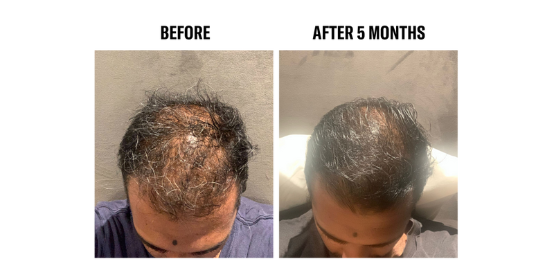 Hair Loss Treatments South Africa | &BAM