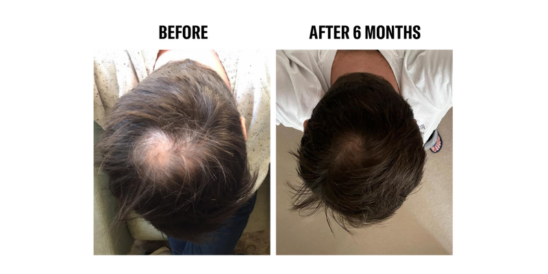 Hair Loss Treatments South Africa Andbam