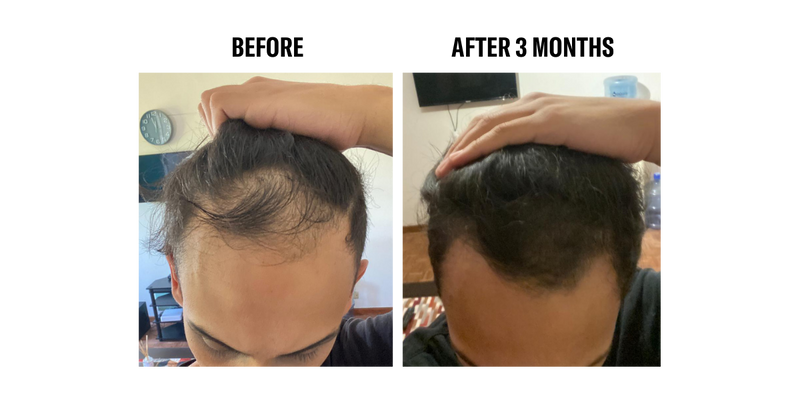 Hair Loss Treatments South Africa | &BAM