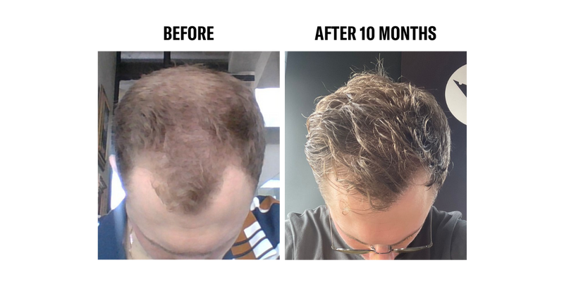 Hair Loss Treatments South Africa Andbam