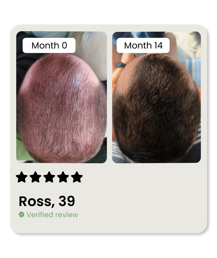 The Best In Mens Care Results Driven Hair Loss Treatment Andbam