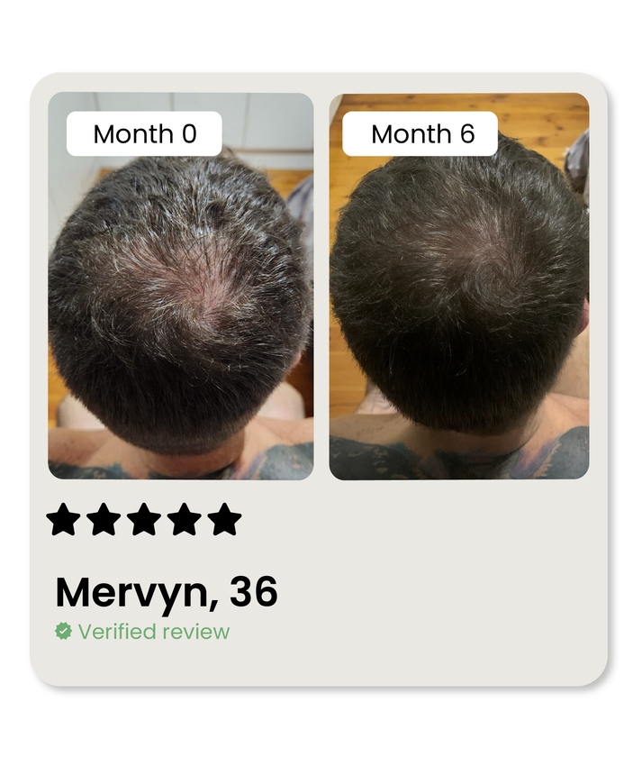 The Best In Mens Care Results Driven Hair Loss Treatment Andbam