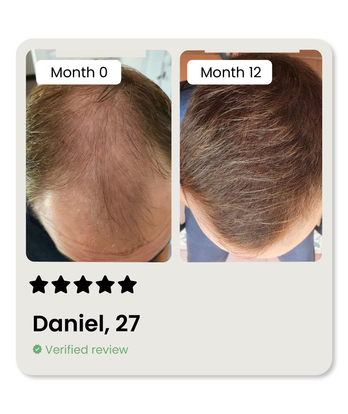 The Best In Mens Care Results Driven Hair Loss Treatment Andbam