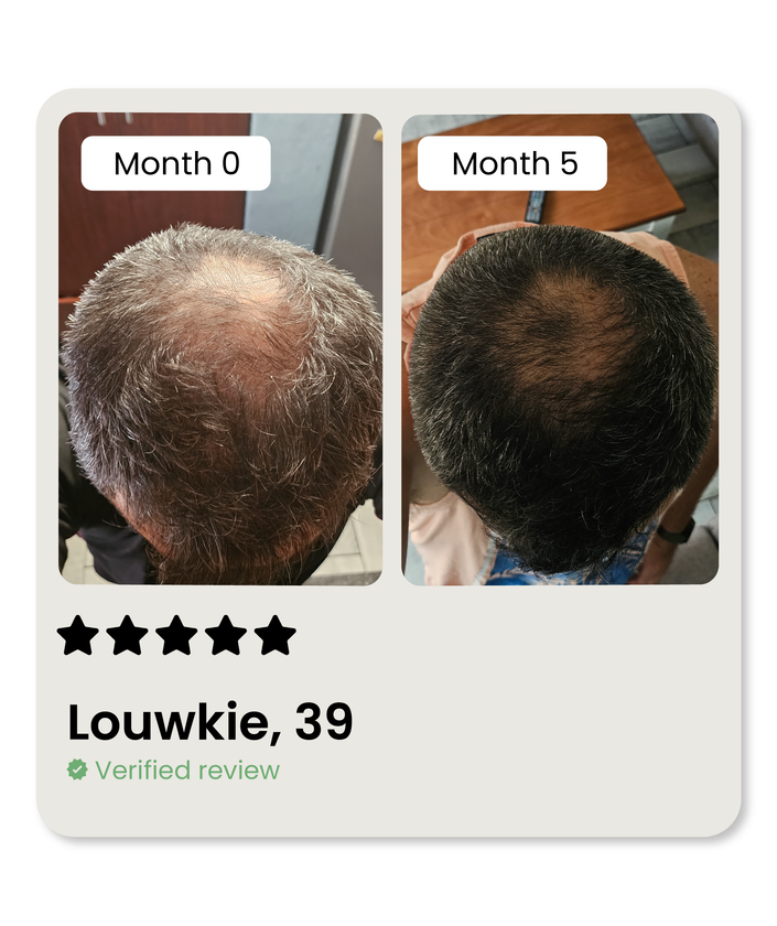 The Best In Mens Care Results Driven Hair Loss Treatment Andbam