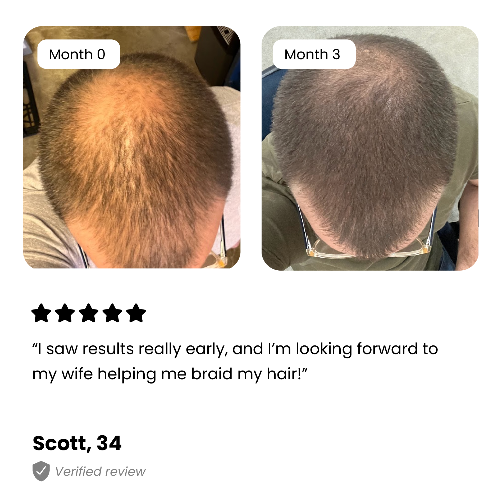 Hair Loss Treatments South Africa | &BAM