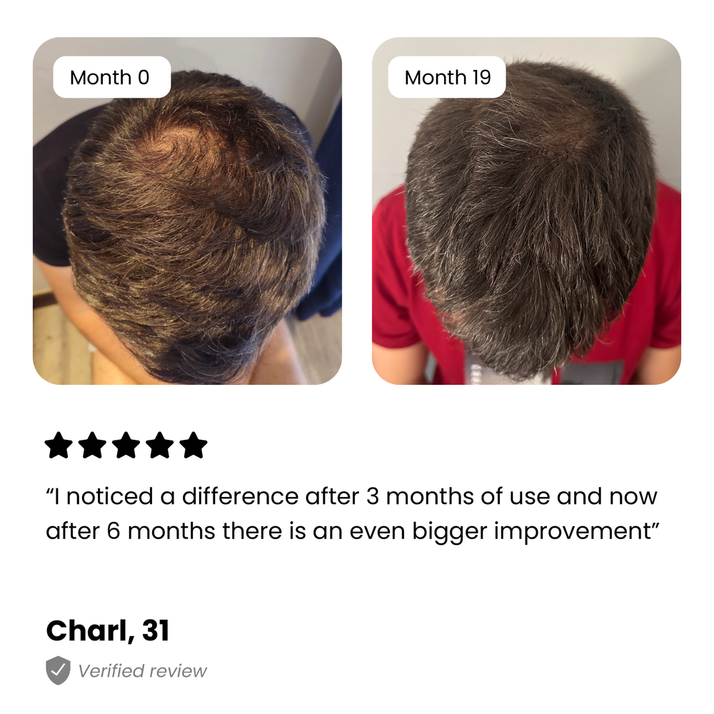 Hair Loss Treatments South Africa | &BAM