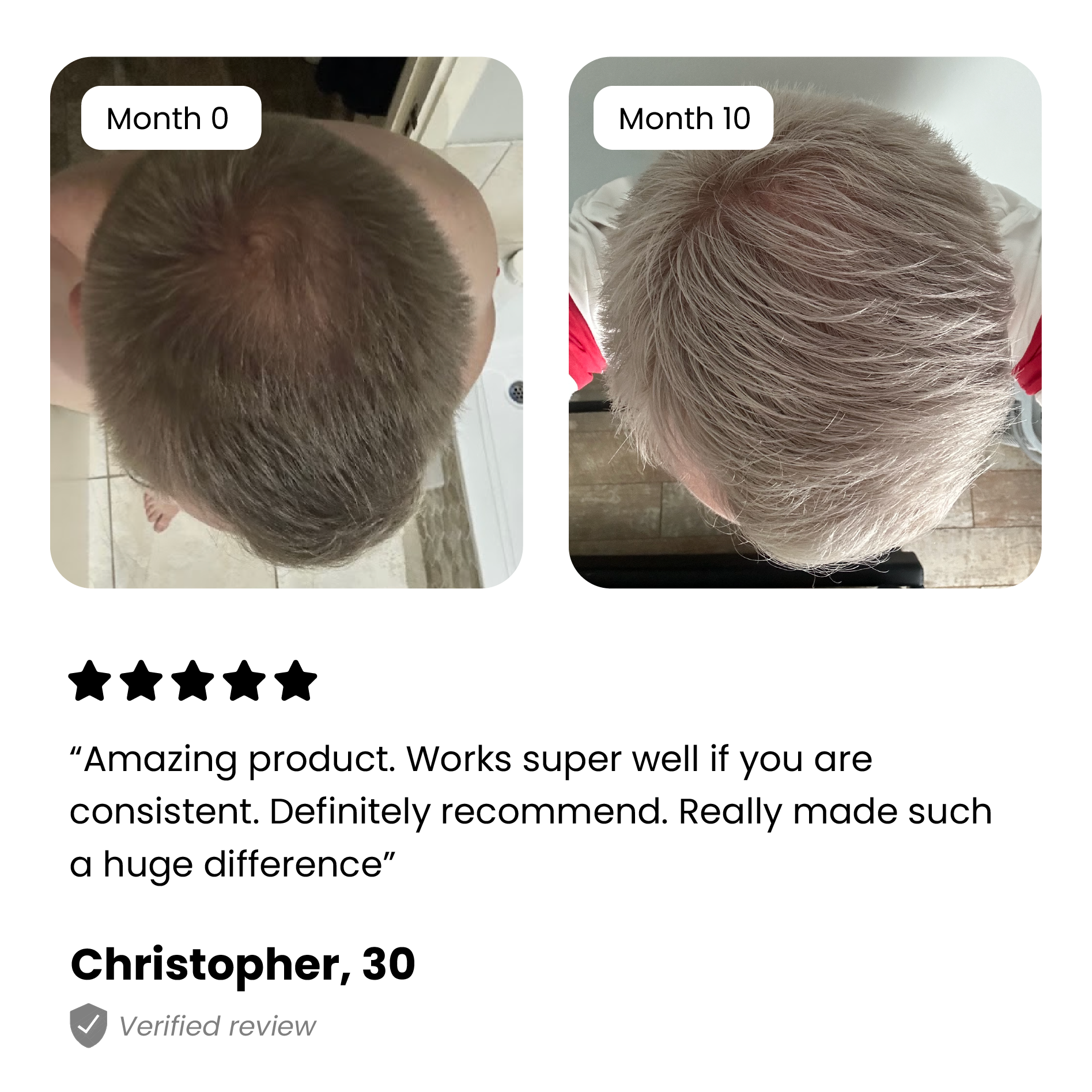 Hair Loss Treatments South Africa | &BAM